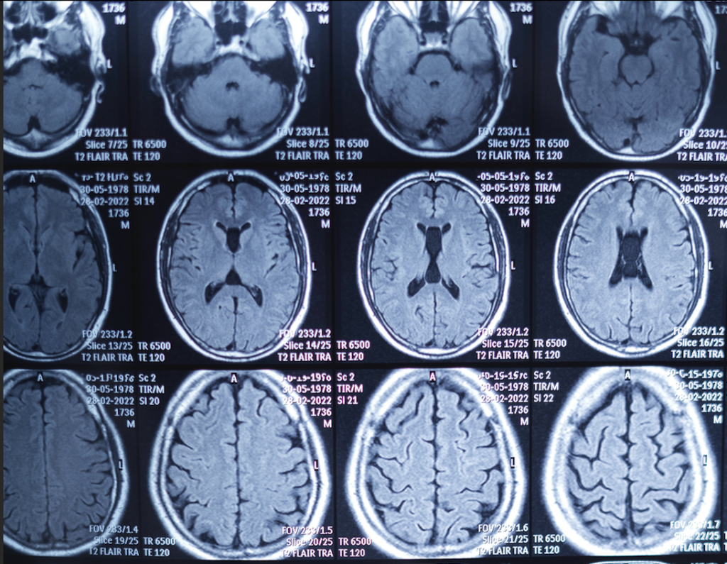 Navigating Life After Brain Injury - Transition Abilities